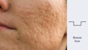 Acne Scars: What they are, 5 Types, Causes and Treatments