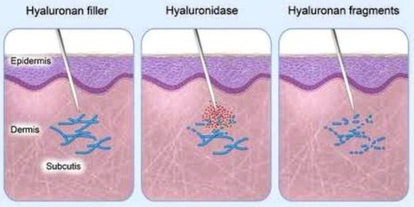 Hyalase: Dissolve Dermal Fillers Naturally in Singapore