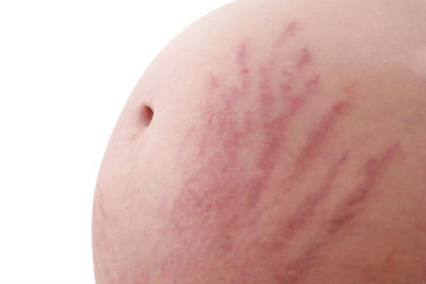 Rosacea Skin Treatments Singapore