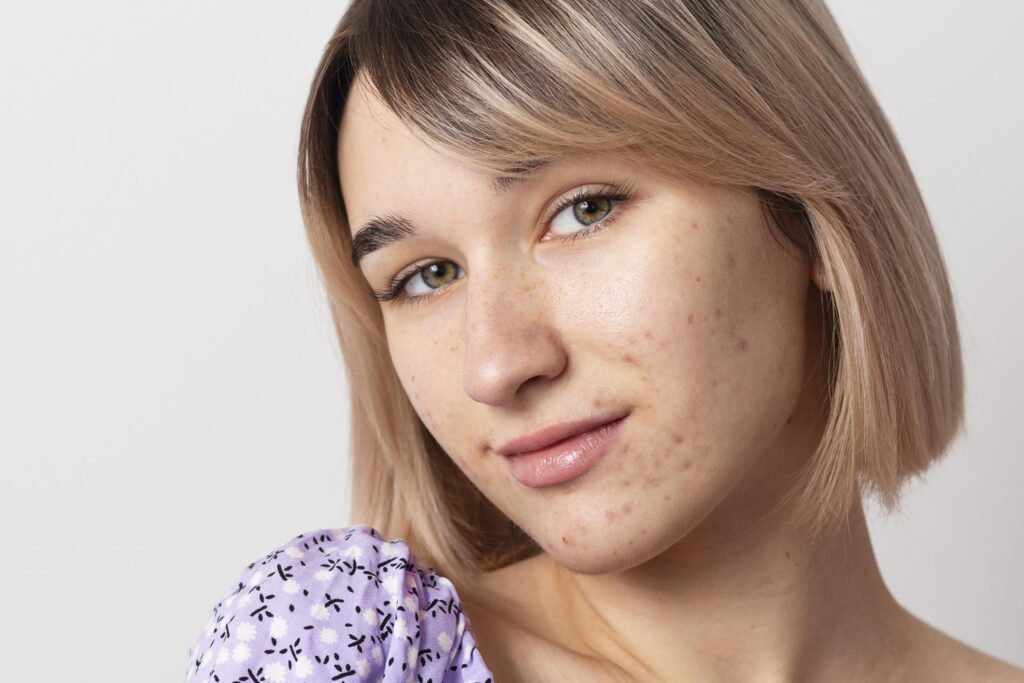 Acne Scar Severity Grading and How It Affects Your Treatment Plan