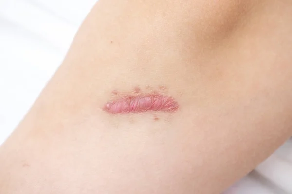 Hypertrophic Scars: What Is It, Causes, Symptoms & Treatment Options