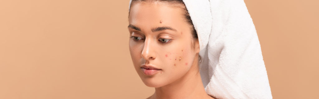 Acne: Causes, Types, and Treatments | Sozo Clinic