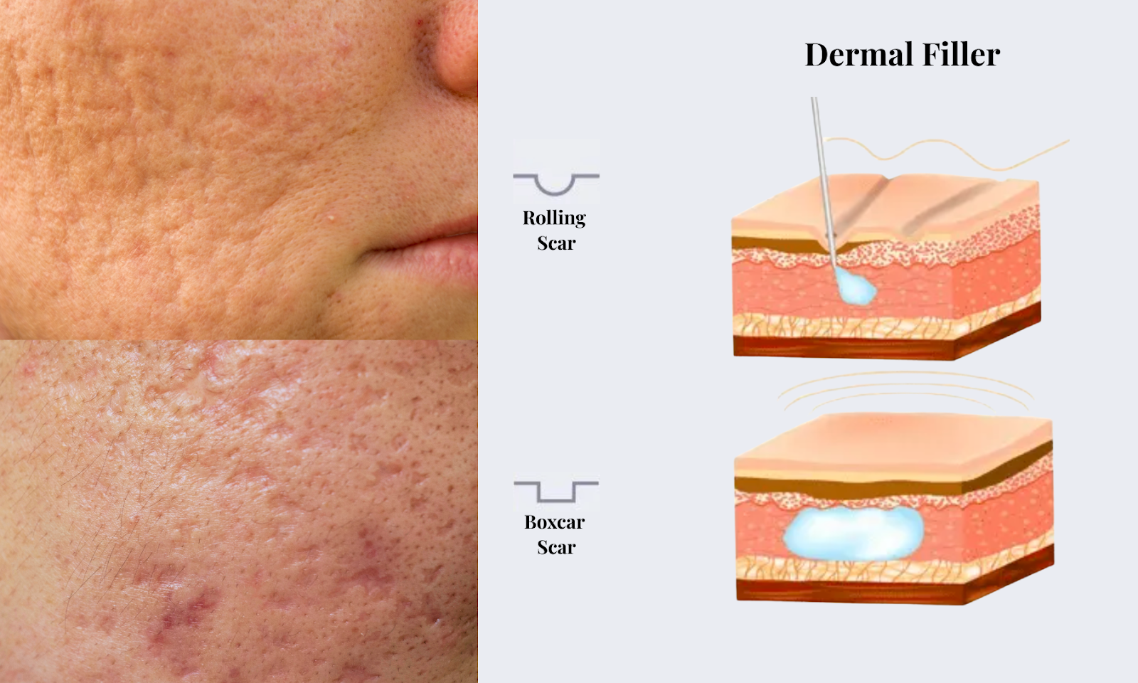 Subcision and Fillers: How They Work Together for Acne Scars