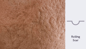 Rolling Acne Scars: Causes, Tethering, and Skin Texture Changes
